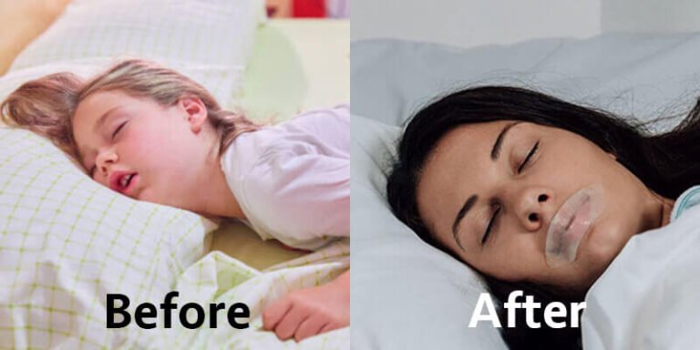 What Is Mouth Tape? How It Works & Why You Should Try It